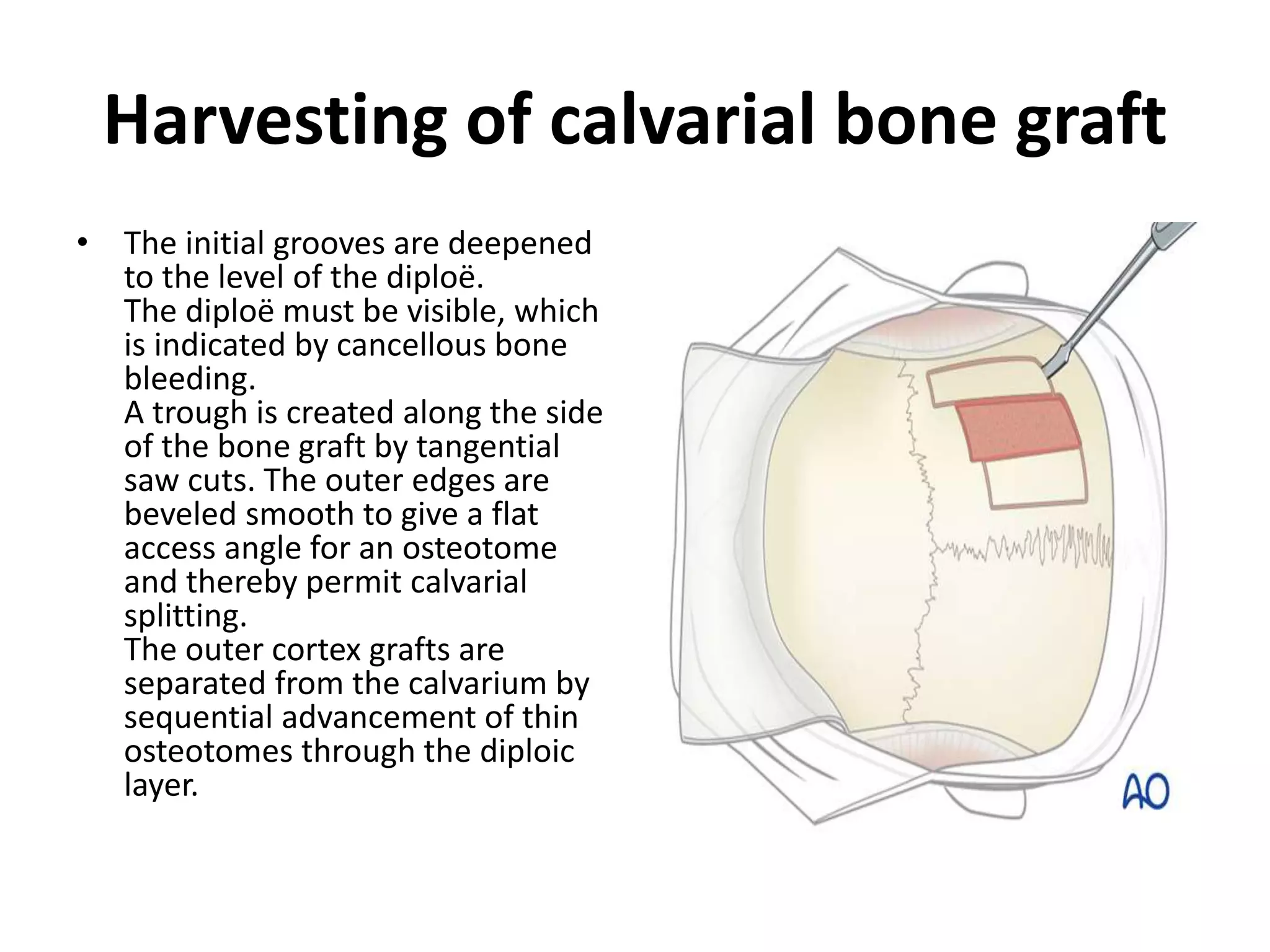 Calvarial bone graf harvesting | PPTX