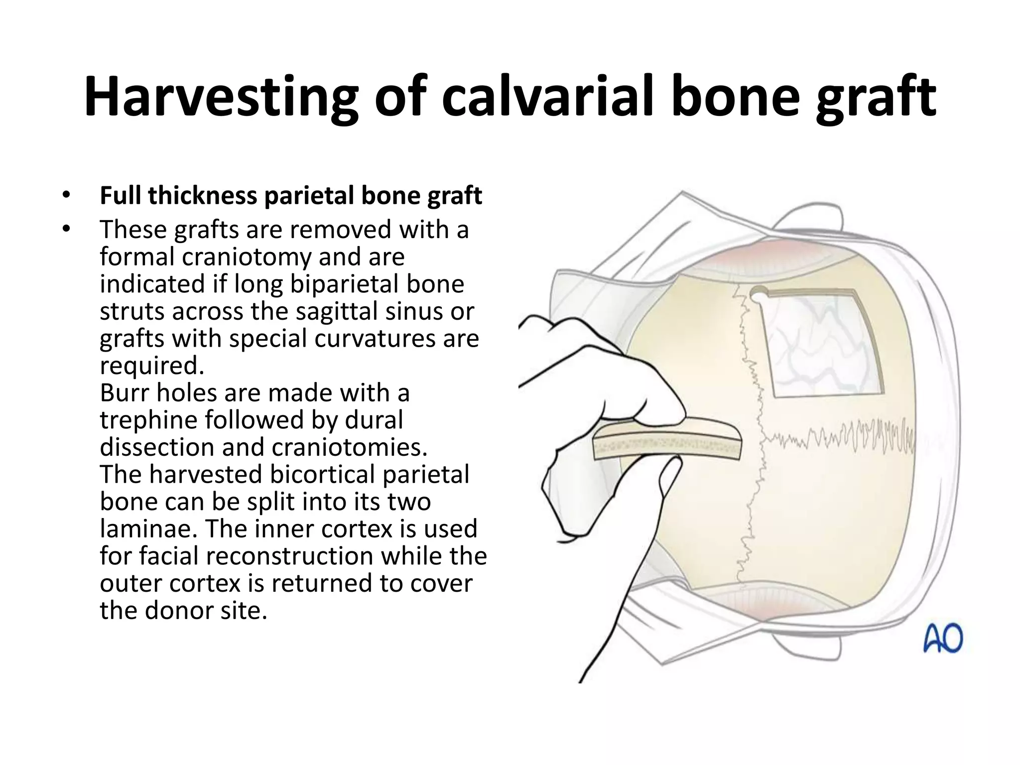 Calvarial bone graf harvesting | PPTX