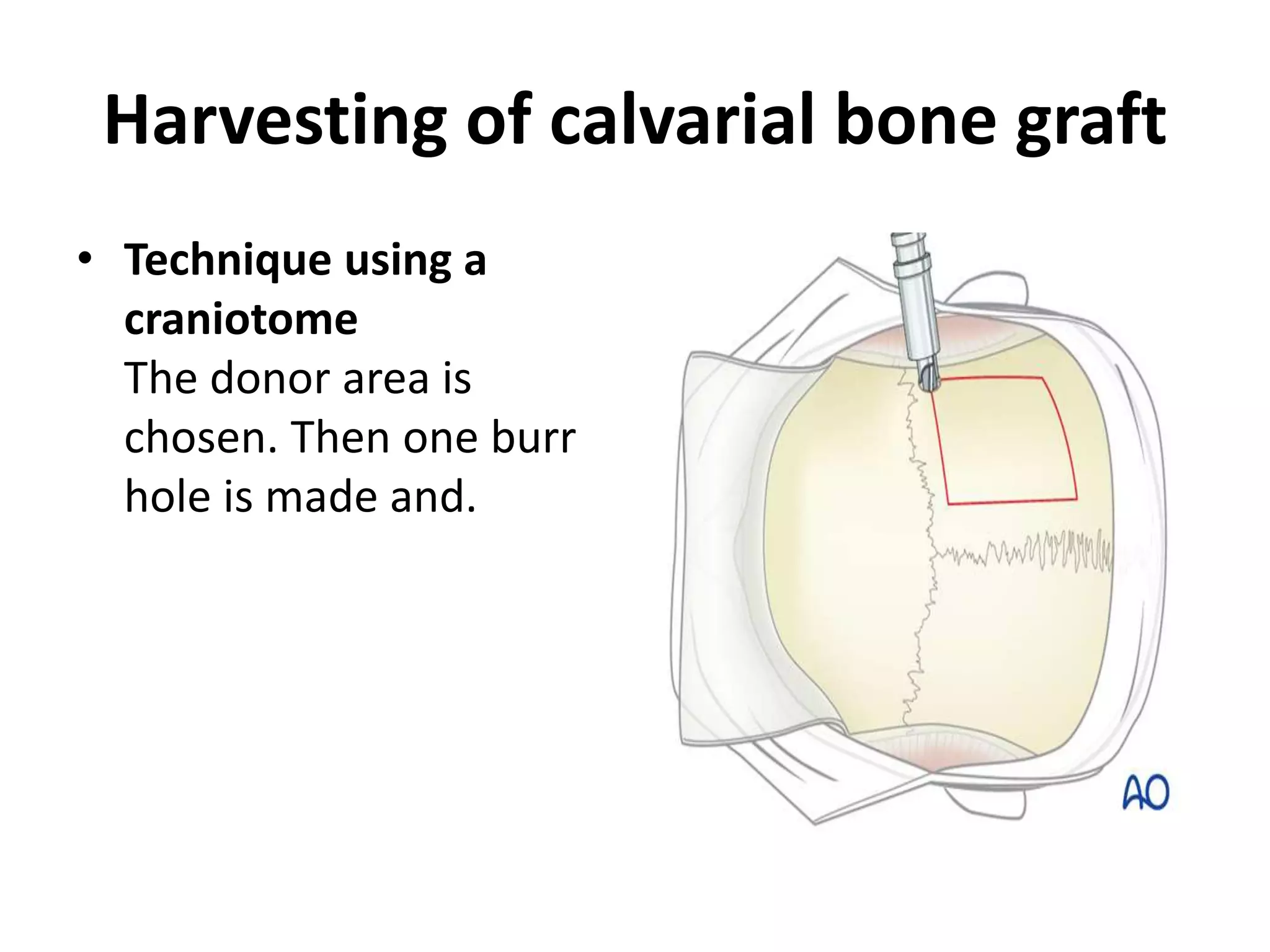 Calvarial bone graf harvesting | PPTX
