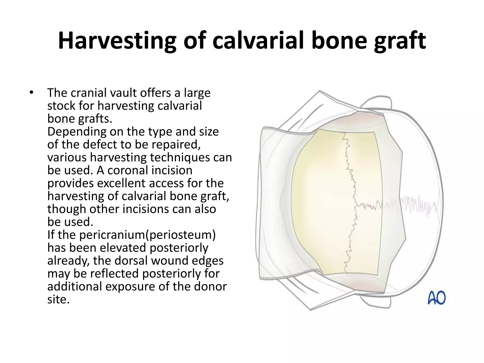 Calvarial bone graf harvesting | PPTX