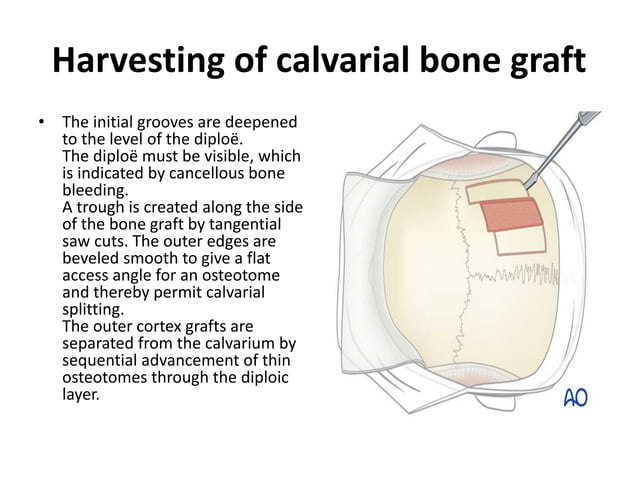 Calvarial bone graf harvesting | PPTX