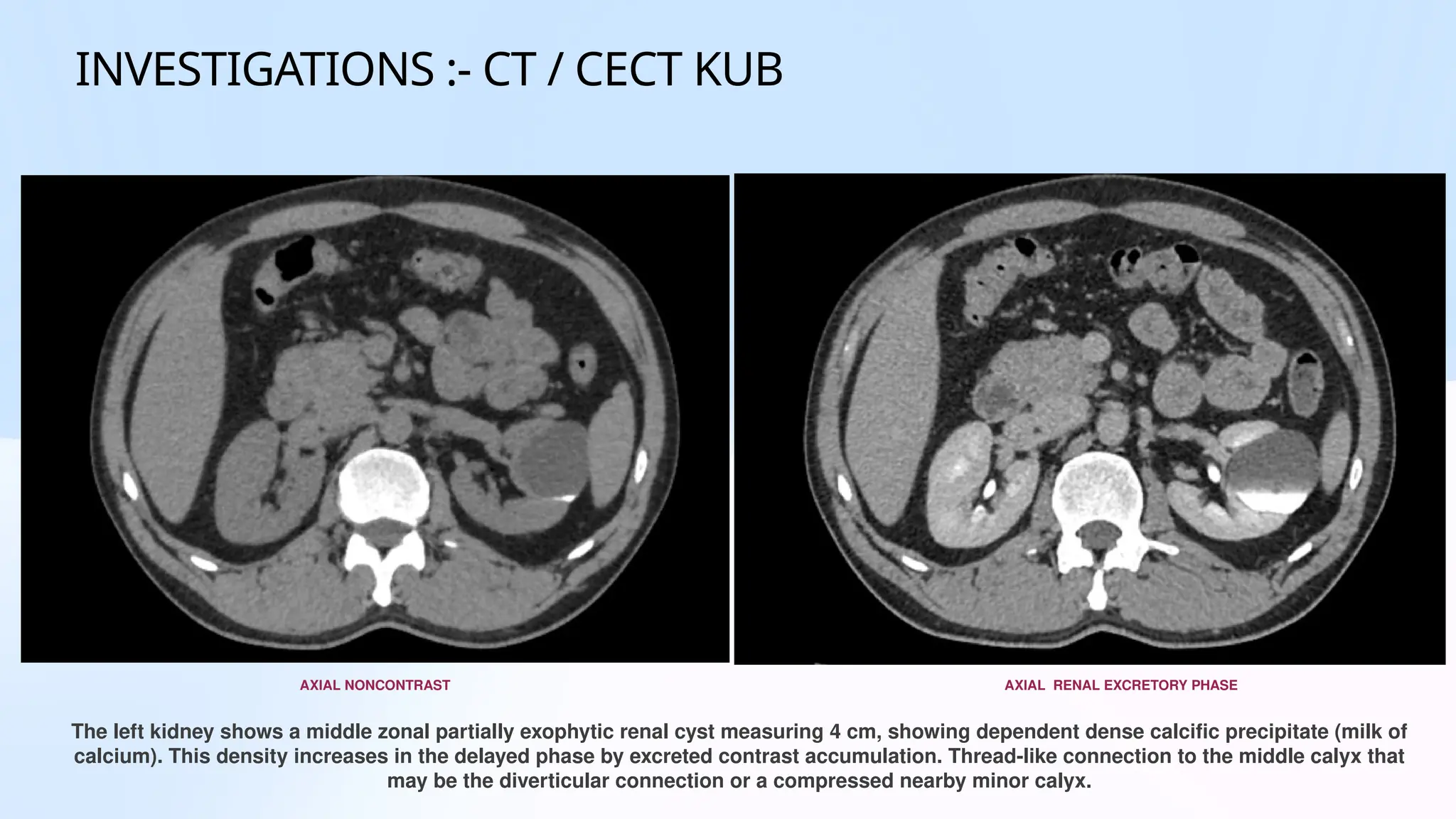 CALYCEAL DIVERTICULUM- THE UNEXPECTED GUEST IN THE KIDNEY.pptx
