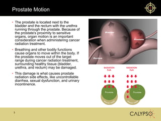 Calypso Prostate Radiation Treatment | PPT