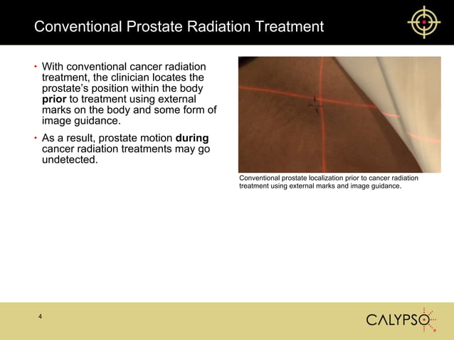 Calypso Prostate Radiation Treatment | PPT