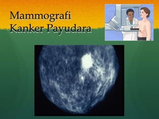 CA Mammae.pptx