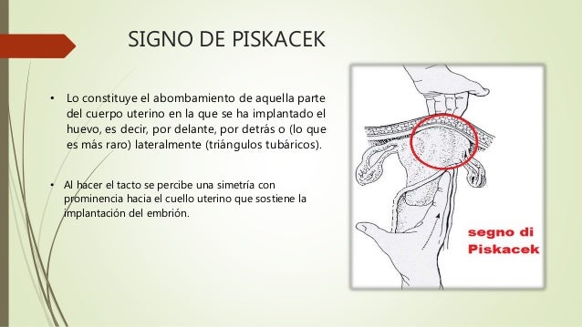 Cambios en-la-forma-uterina