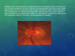 Cambios papilares en el glaucoma | PPTX