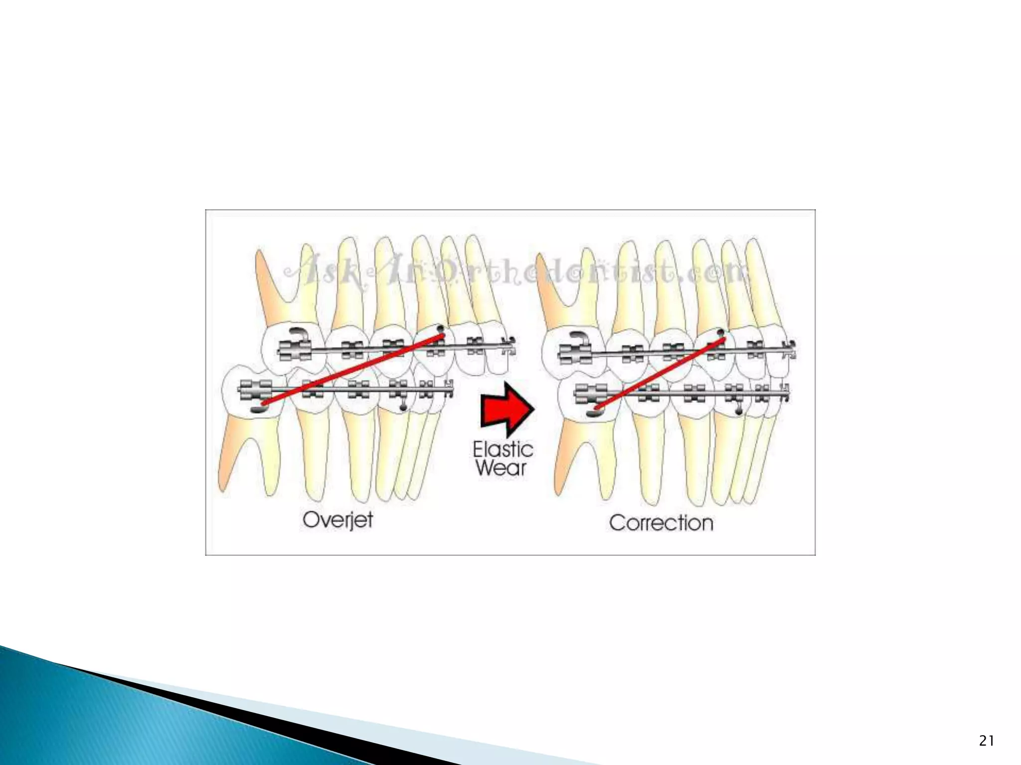 Camouflage in orthodontics | PPTX
