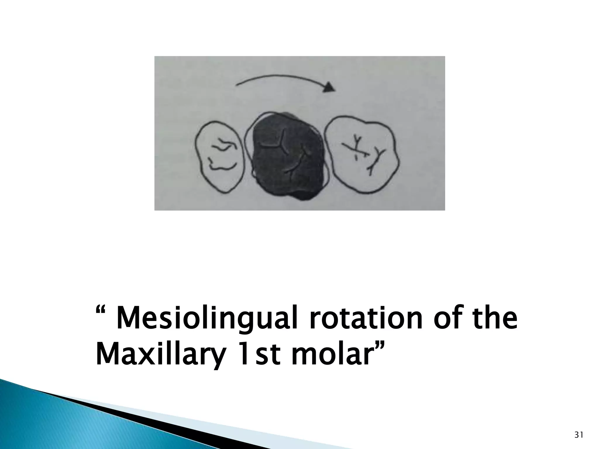 Camouflage in orthodontics | PPTX