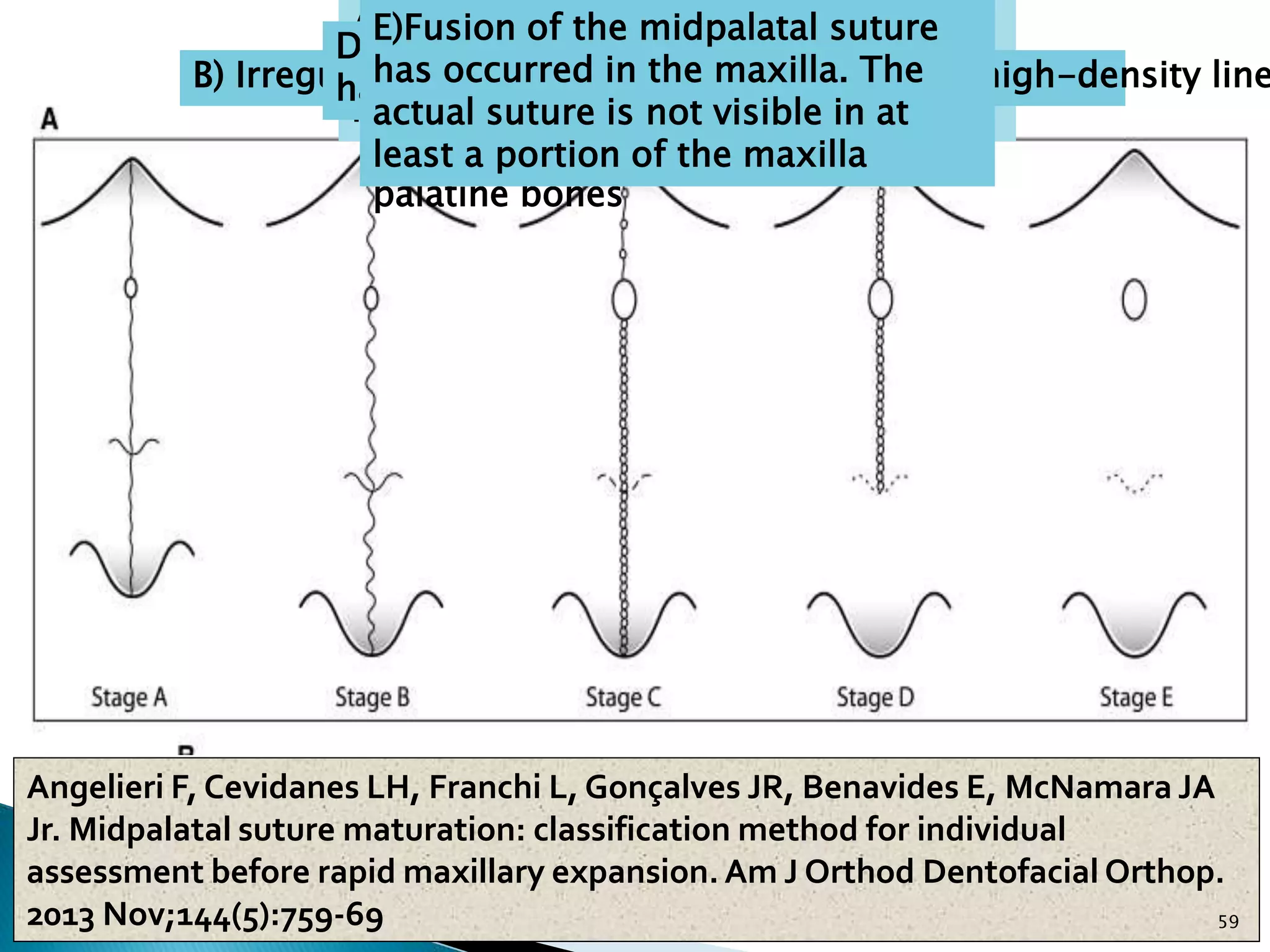 Camouflage in orthodontics | PPTX