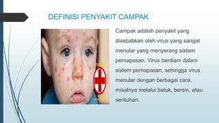 Campak | PPT