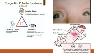 Campak dan Rubella.pptx