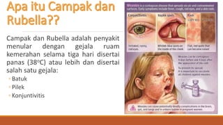 Campak dan Rubella.pptx