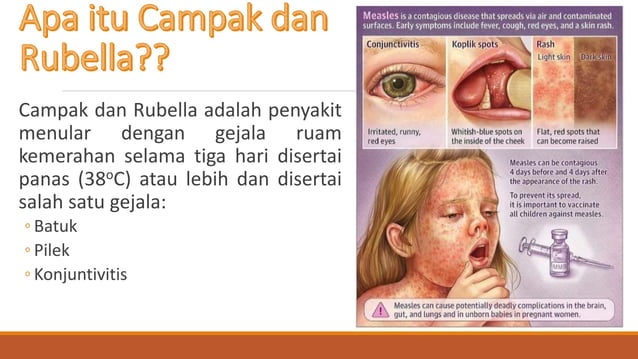Campak dan Rubella.pptx