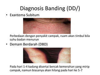 Campak PPT TROPIS.pdf