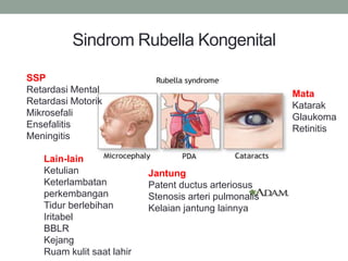 CAMPAK RUBELLA.pptx