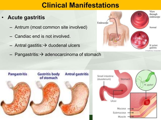 Campylobacter & Helicobacter.ppt