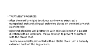 Canine transposition | PPTX
