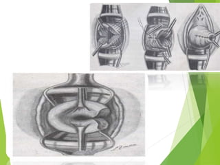 CANAL BLANDO- EPISIOTOMIA Y DESGARROS OBSTETRICOS | PPTX