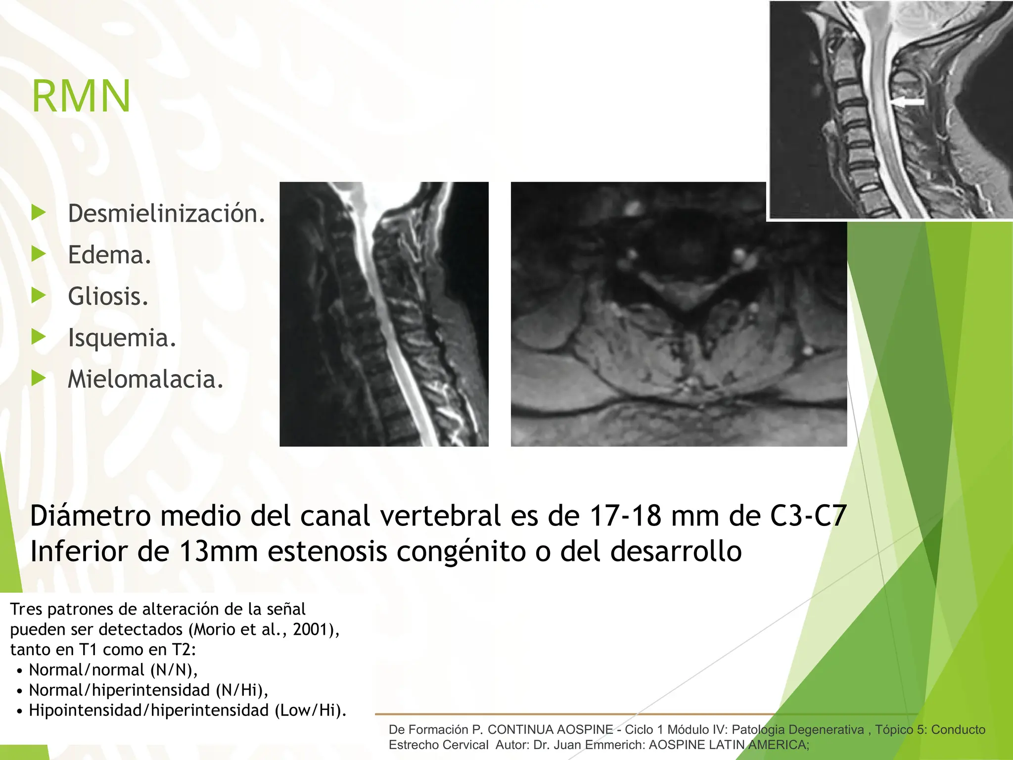 canal cervical estrecho ORTOPEDIA Y TRAUMATOLOGIA DE COLUMNA | PPT