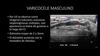 Canal inguinal | PPTX