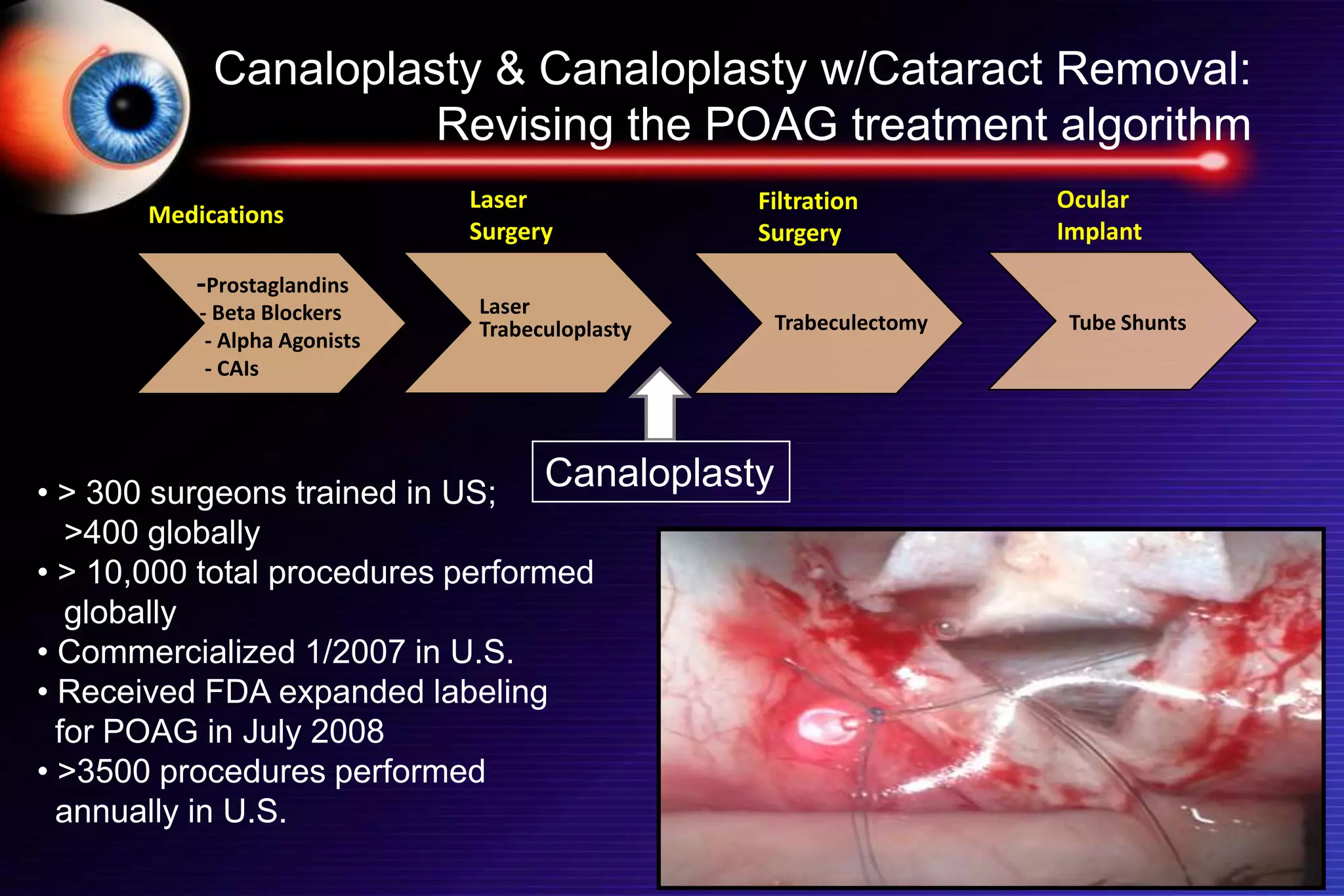 Canaloplasty Overview 3 Year Clinical Results Burchfield111510 | PPT ...