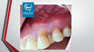 Canal preparation using Mpro rotary system | PPTX