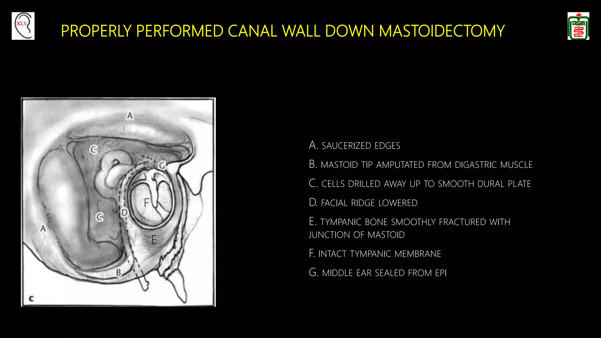 Canal Wall Down Mastoidectomy(MRM) | PPTX