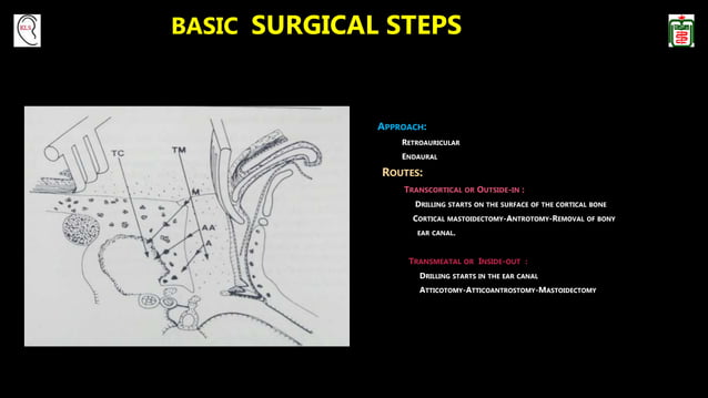 Canal Wall Down Mastoidectomy(MRM) | PPTX | Ear, Nose and Throat ...