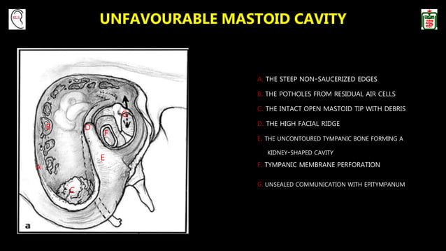 Canal Wall Down Mastoidectomy(MRM) | PPTX | Ear, Nose and Throat ...