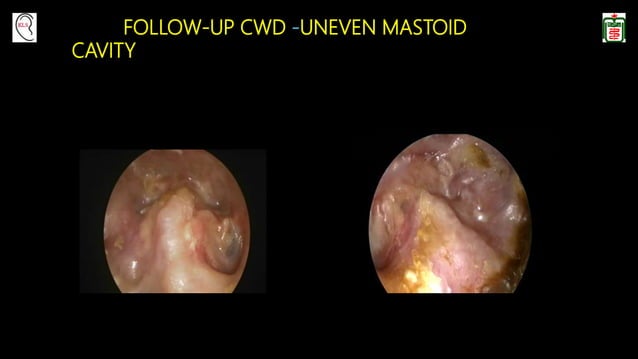 Canal Wall Down Mastoidectomy(MRM) | PPTX | Ear, Nose and Throat ...