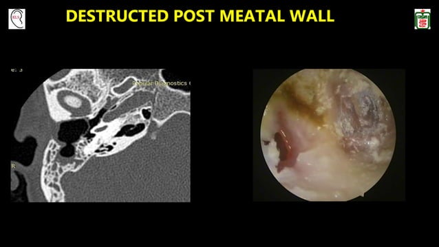 Canal Wall Down Mastoidectomy(MRM) | PPTX | Ear, Nose and Throat ...