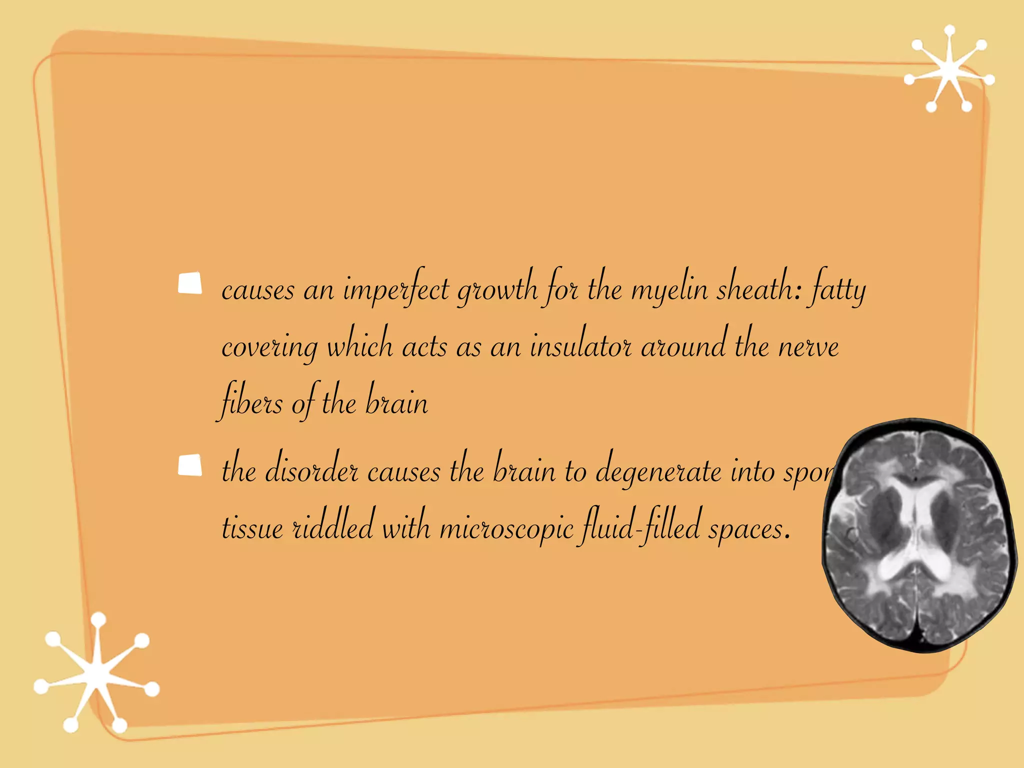 Canavan disease | KEY
