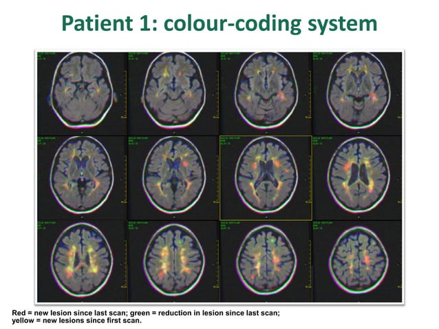 Can brain atrophy measurement help us in monitoring MS progression in ...