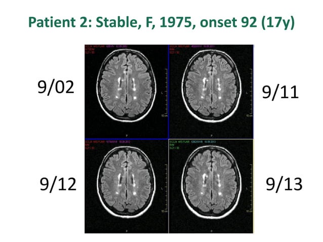 Can brain atrophy measurement help us in monitoring MS progression in routine clinical practice ...