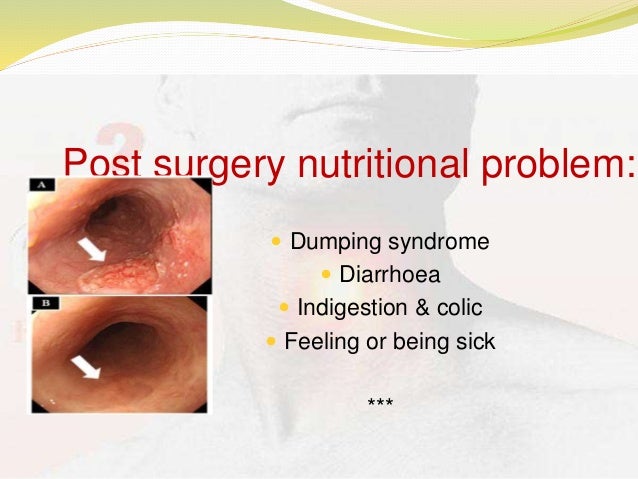 Diet Post Stomach Cancer Surgery - Travellin