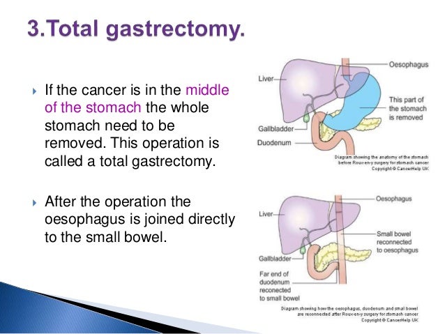 Upper Partial Gastrectomy Diet - cloudnews