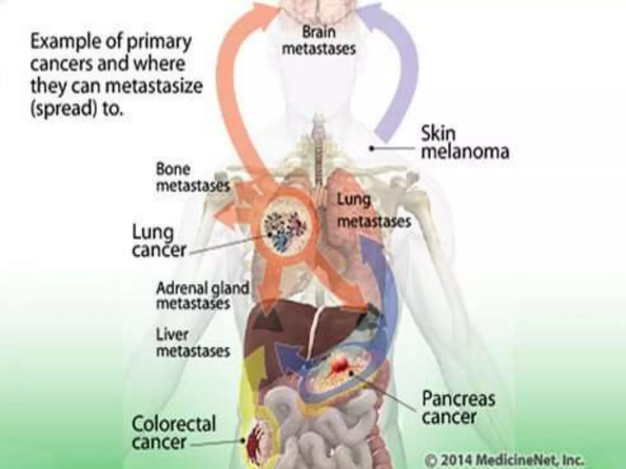 Cancer - Types ,spread and properties | PPTX
