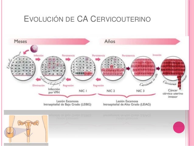 Cancer Cervicouterino