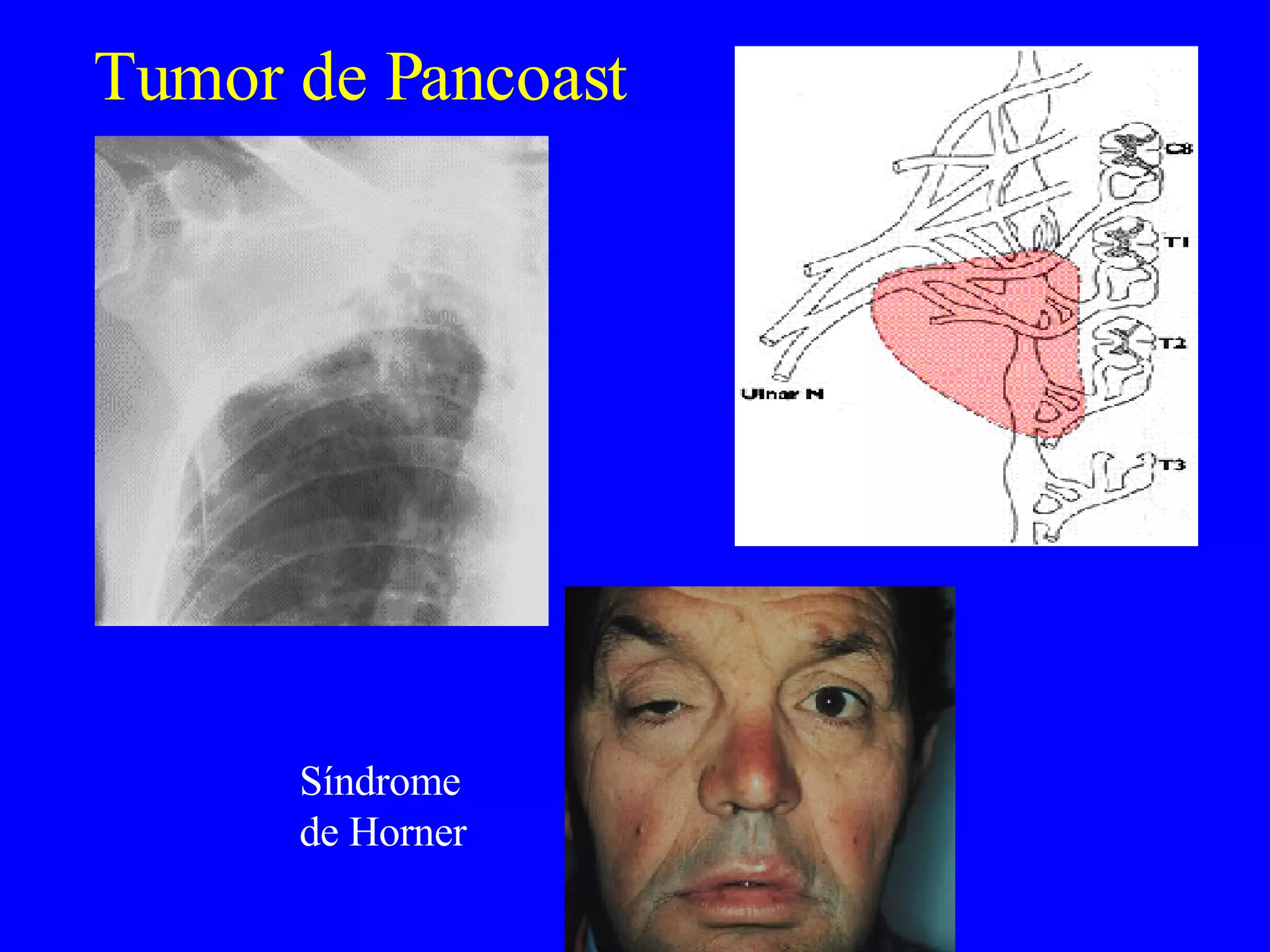 Cancer De Pulmón 2005 Ppt