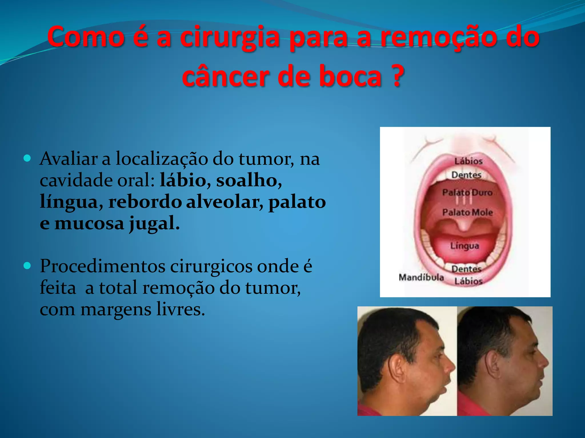 Cancer boca | PPTX