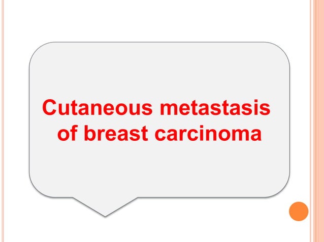 cutaneous metastasis of breast cancer | PPT