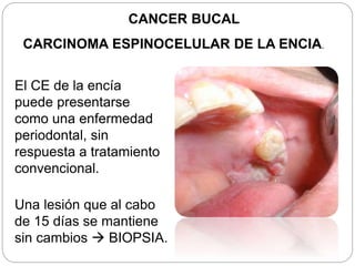 Cancer bucal | PPTX