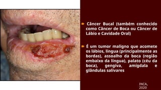 AULA DE CÂNCER BUCAL - ODONTOLOGIA.pptx