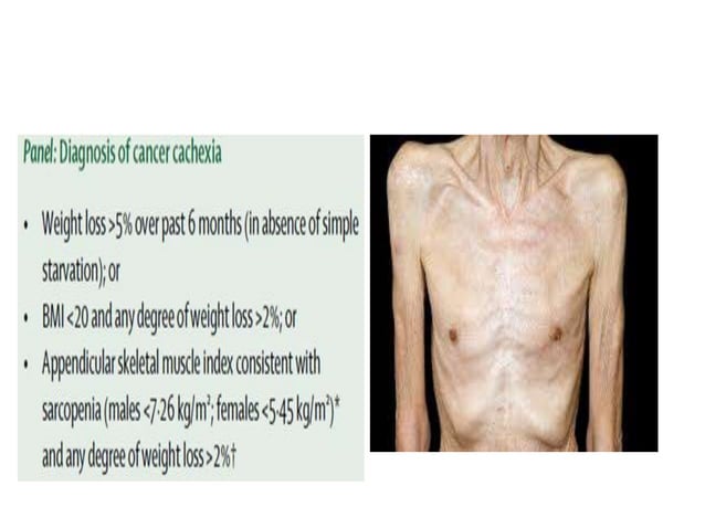 Cancer cachexia | PPTX