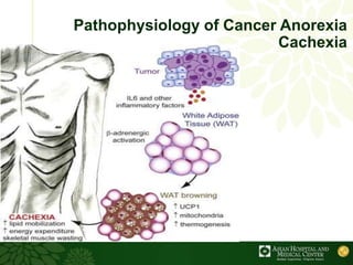 Cancer cachexia | PPTX