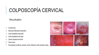 Cancer cervico uterino | PPTX