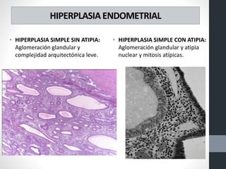 Cancer cervico uterino | PPTX
