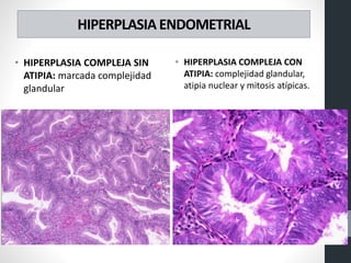 Cancer cervico uterino | PPTX