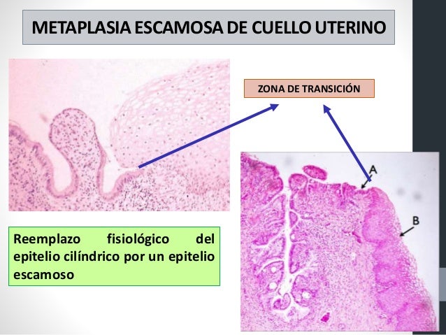 Cancer cervico uterino